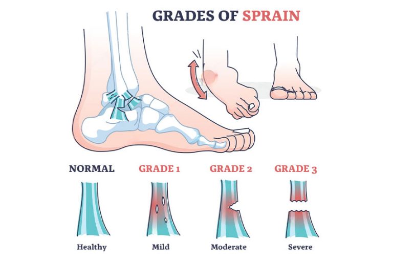 Does Walking On A Sprained Ankle Make It Worse?