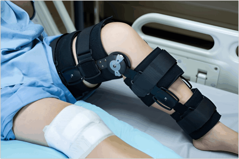 ACL Recovery Timeline: Healing Stages and Treatment Guide